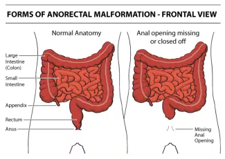 Anorectal Malformation | General Surgery