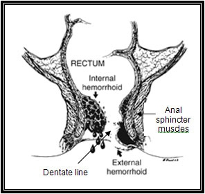 Hemorrhoidectomy | General Surgery