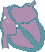 Atrioventricular Heart Block | General Surgery